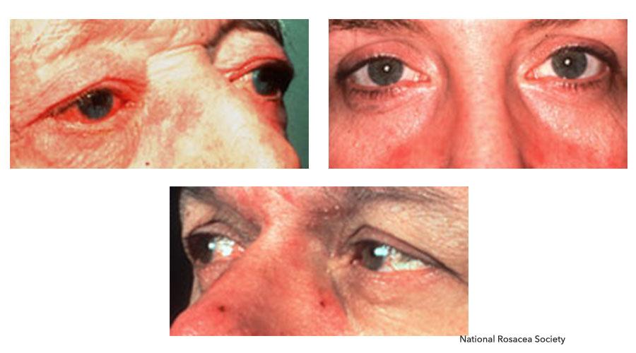 Treatment for Rosacea - Medical Dermatology | Inverness Dermatology ...